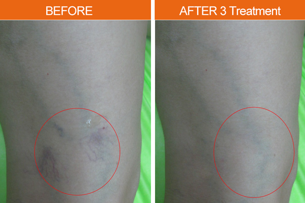 magma-before-after-12 - La Compagnie des Lasers