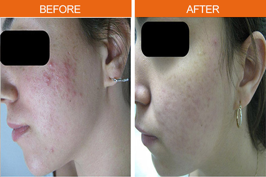 magma-before-after-3 - La Compagnie des Lasers