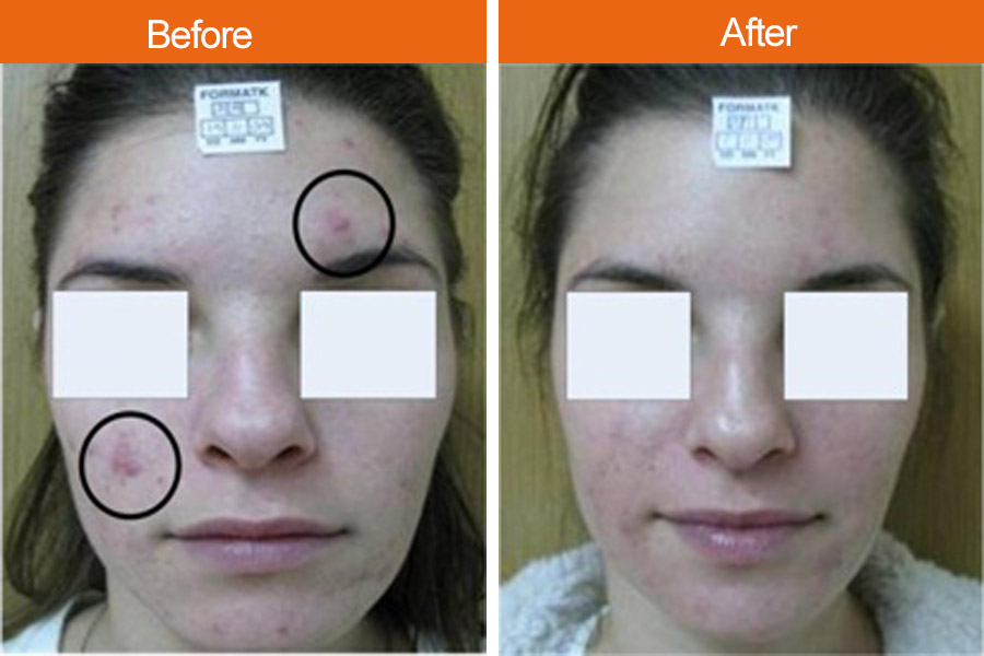 magma-before-after-4 - La Compagnie des Lasers