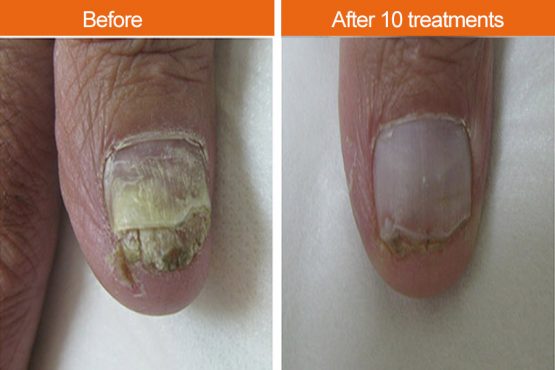 magma-before-after-5 - La Compagnie des Lasers