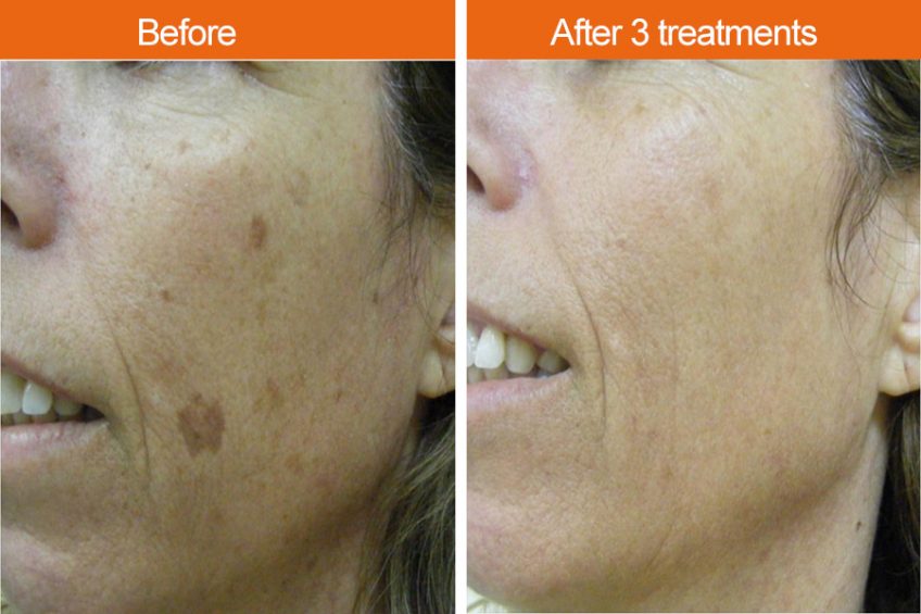 magma-before-after-7 - La Compagnie des Lasers